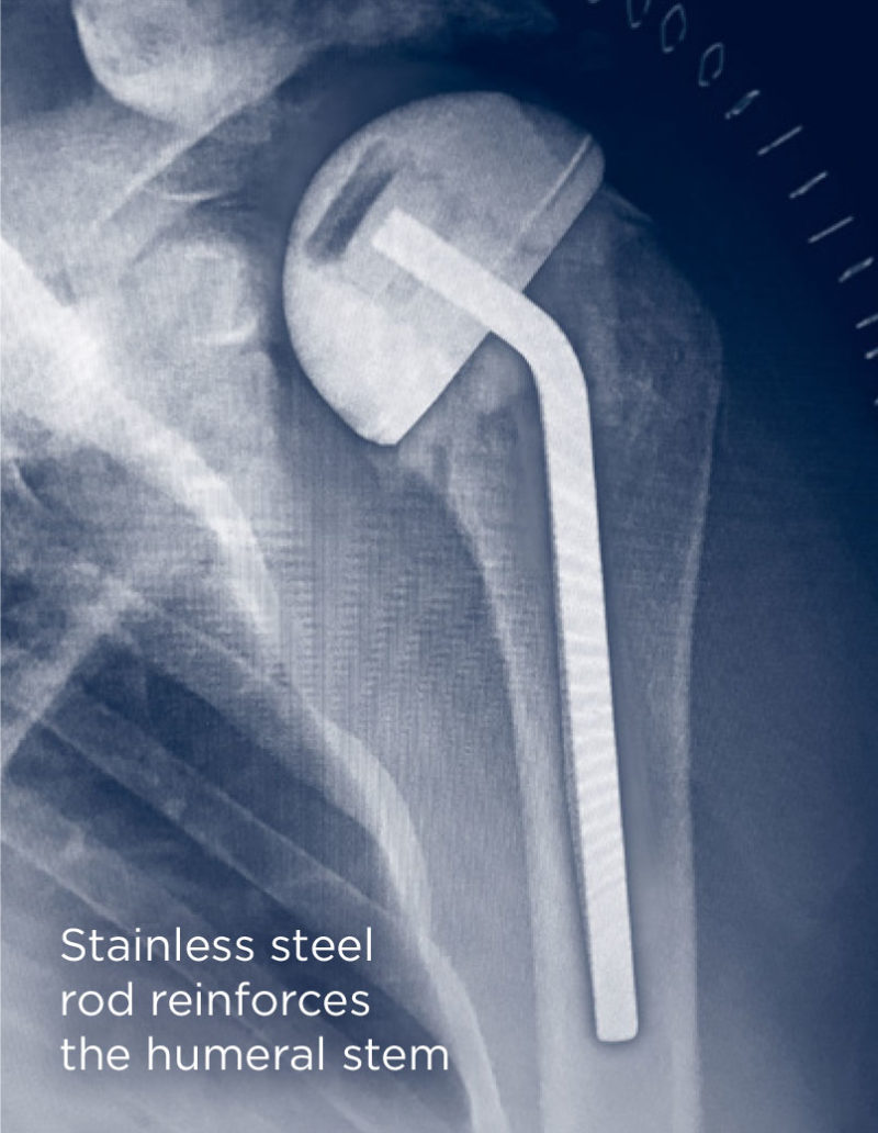 Remedy Shoulder System - Osteo Remedies - Home of REMEDY® HIP, REMEDY ...