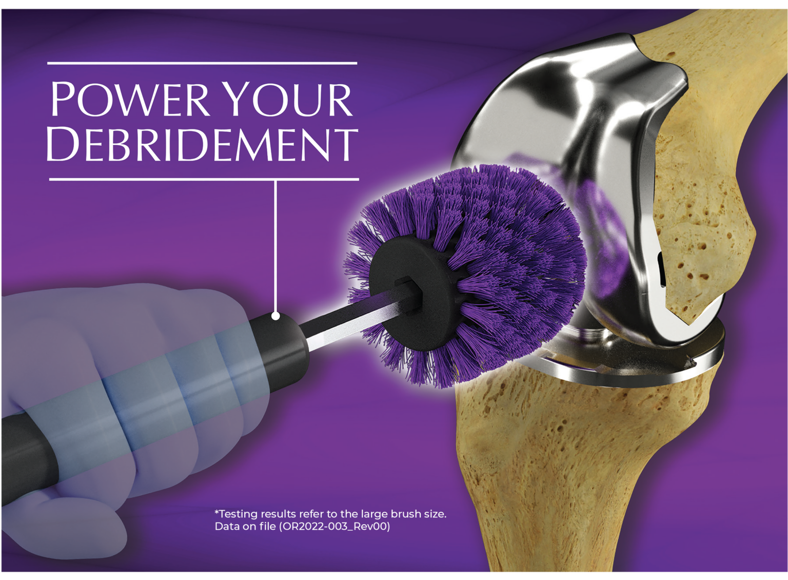 BIOBRUSH™ POWERED DEBRIDMENT DEVICE - Osteo Remedies - Home of REMEDY ...
